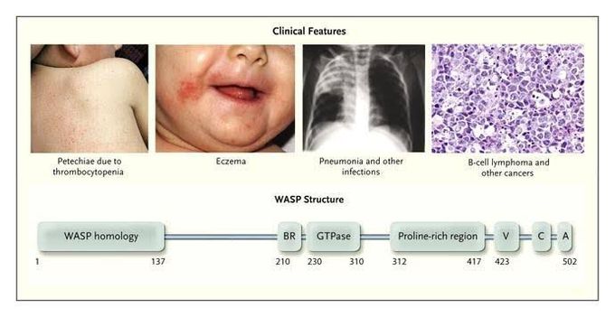 Symptoms of wiskott aldrich syndrome - MEDizzy