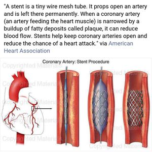 Coronary artery stent. - MEDizzy
