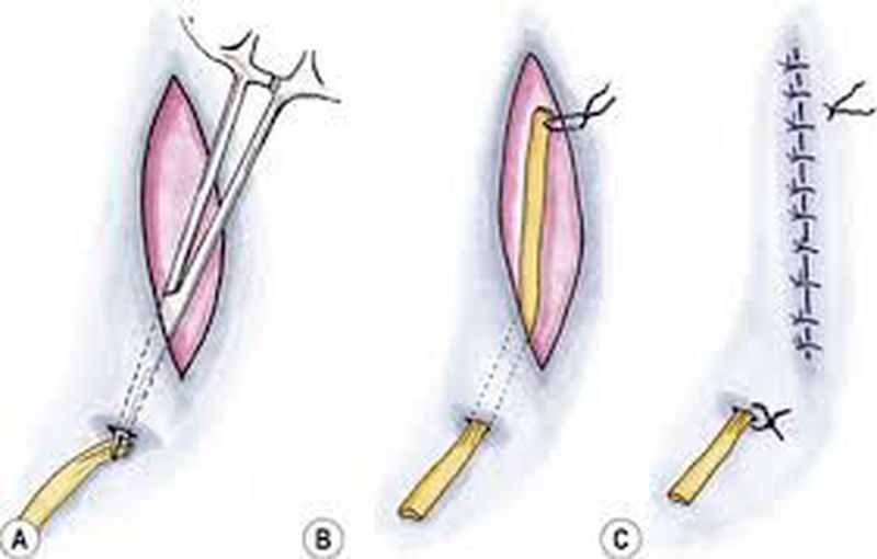 Penrose Drain Abdomen