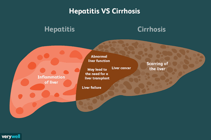 Hepatitis - MEDizzy