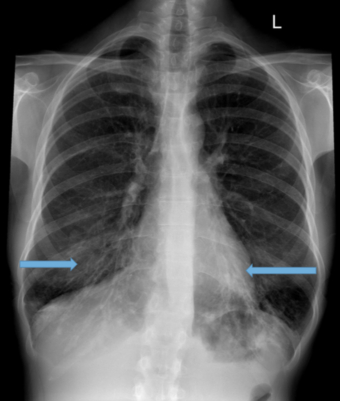 Tram Tracking On Chest X ray In A Patient With MEDizzy