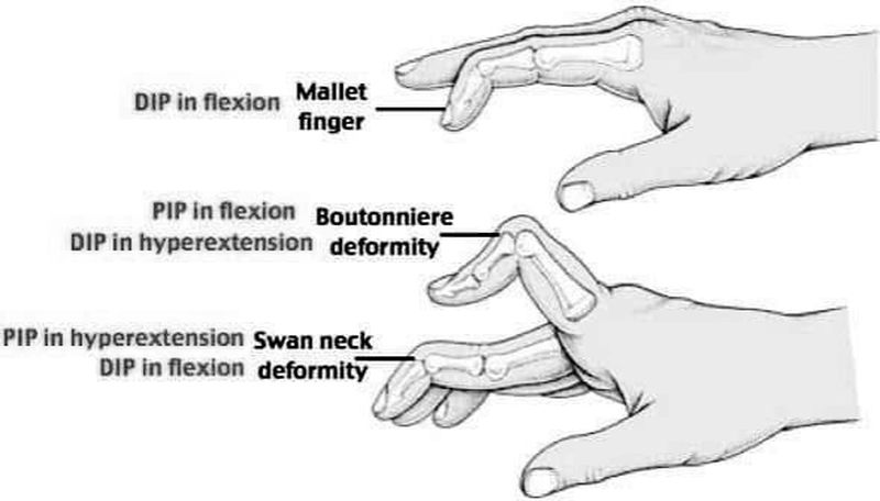 finger flexion deformity