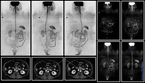 Whole Body DWI performed direct coronal. Achieving both - MEDizzy