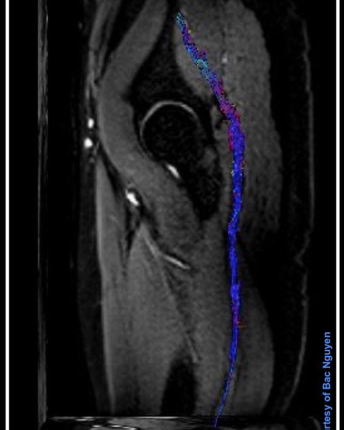 Sciatic nerve (DTI) @ Siemens 3T Prisma#Siemens_MRI #mri - MEDizzy