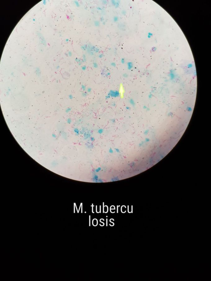 Mycobacterium tuberculosis seen by Z N staining. - MEDizzy