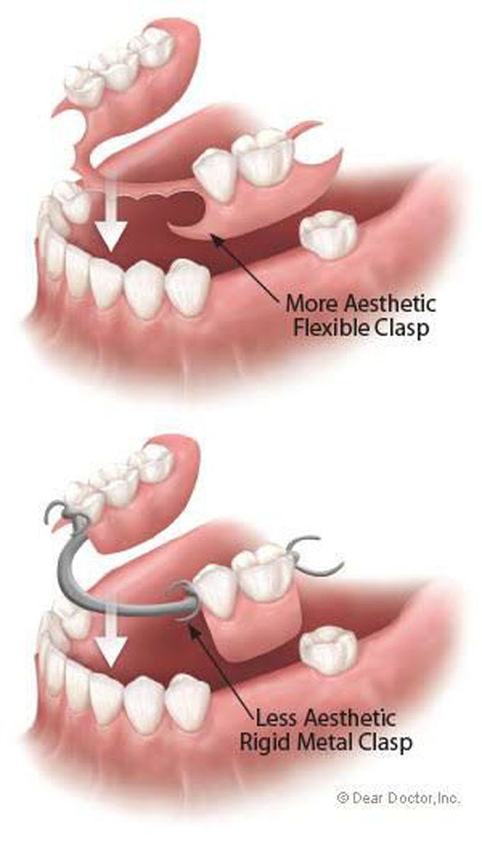 Typs of removable partial denture - MEDizzy