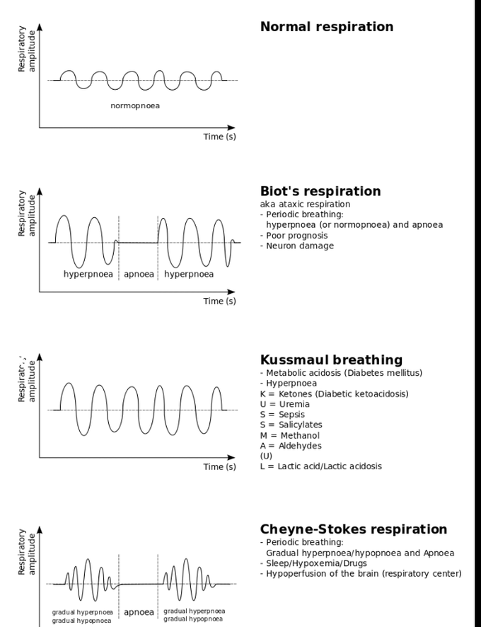 Kussmaul Breathing Pattern