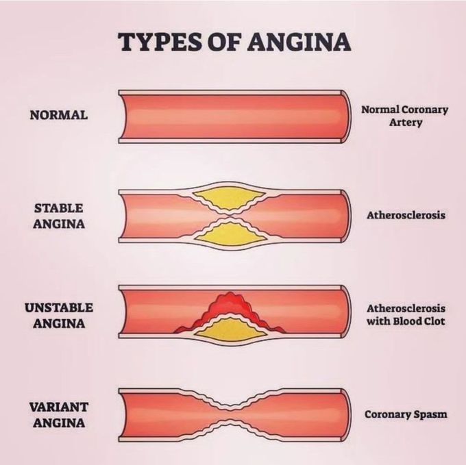 Types of Angina - MEDizzy