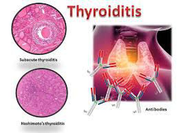 Thyroiditis - MEDizzy
