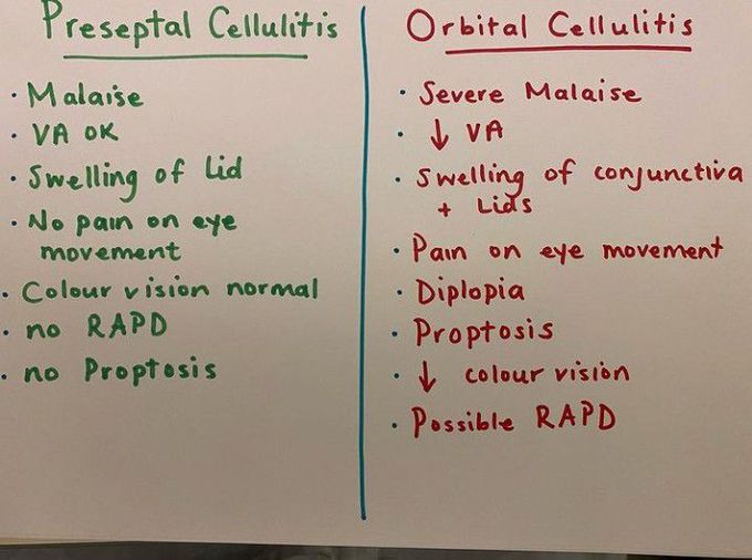 Preseptal Cellulitis Vs Orbital Cellulitis