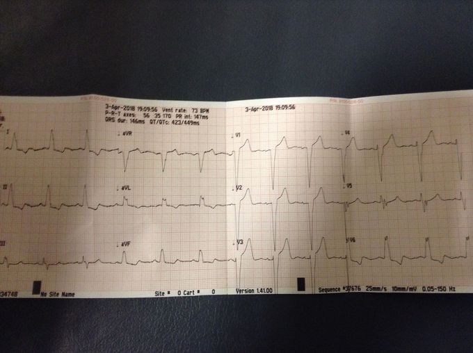 ECG paper - MEDizzy