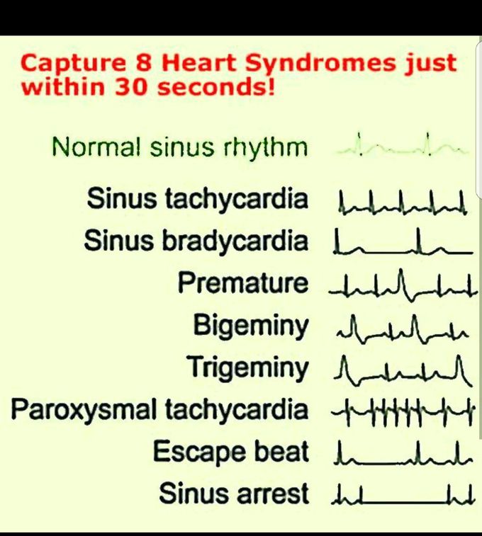 Different Heart rates - MEDizzy