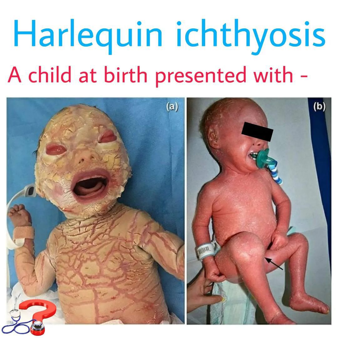 ichthyosis uk