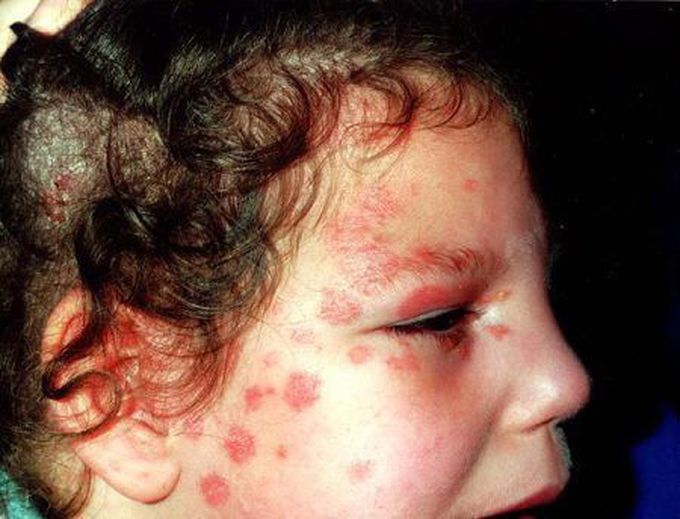 A 4-year-old girl presented with a circular reddish skin - MEDizzy