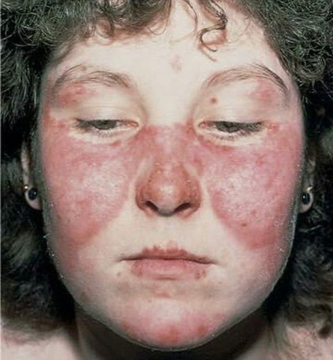 Rash known as MALAR rash seen in? - MEDizzy