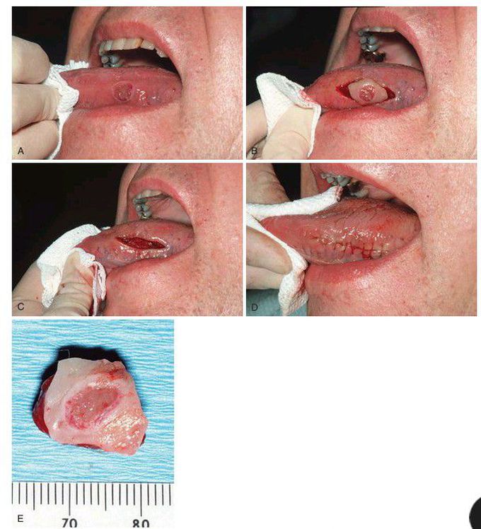Excisional Biopsy Of A Tongue Ulcer MEDizzy
