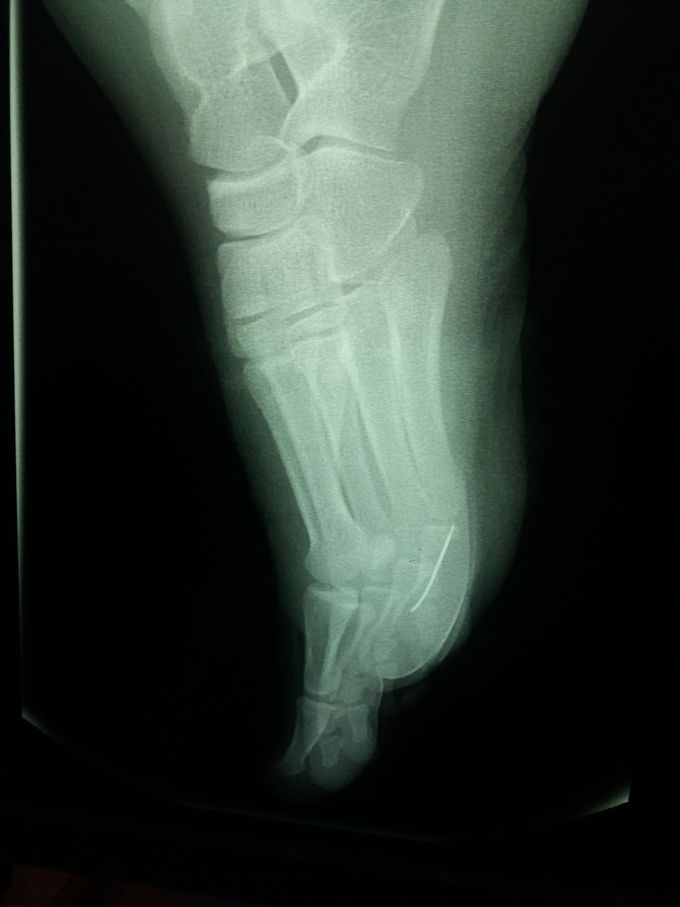 Foreign body - MEDizzy