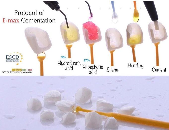 Protocol of Emax Cementation - MEDizzy