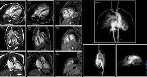 Advanced MRI Cardiac Imaging w/GADOVIST @ Siemens 1.5T Aera - MEDizzy