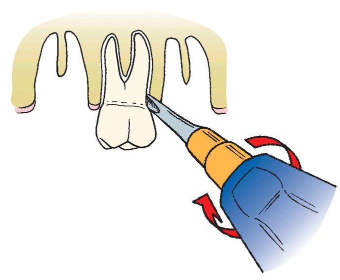 Luxation of tooth - MEDizzy