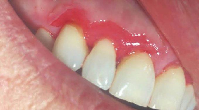 Desquamative gingivitis - MEDizzy