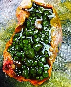 Cholelithiasis: "Formation of stones in the gallbladder". - MEDizzy
