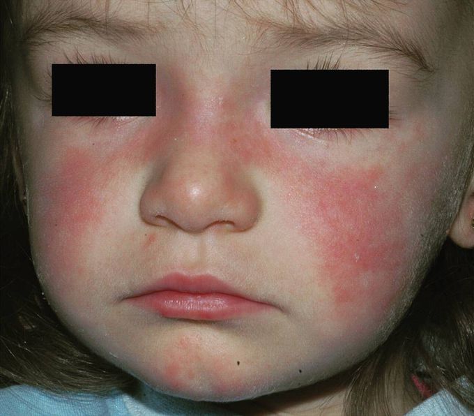 Butterfly Malar Rash MEDizzy