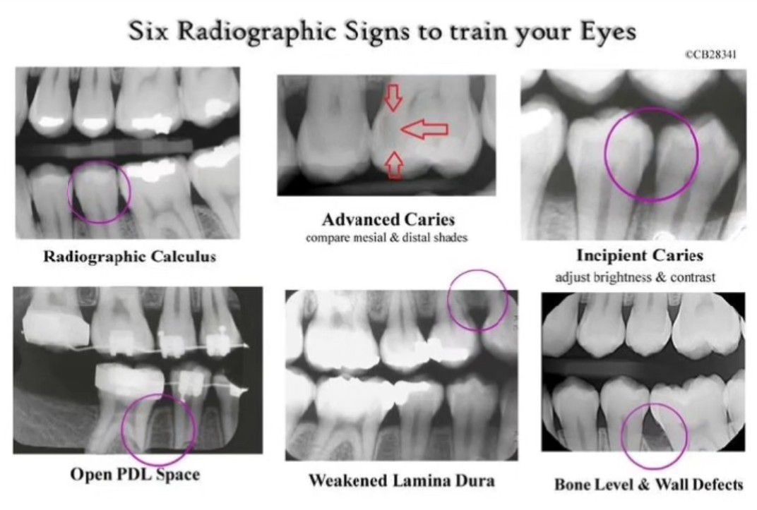 Periapical Radiographs - MEDizzy