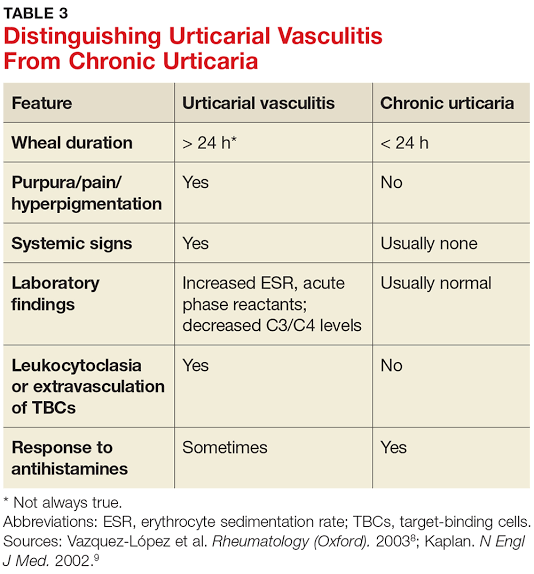 Urticarial Vasculitis And Chronic Urticaria MEDizzy