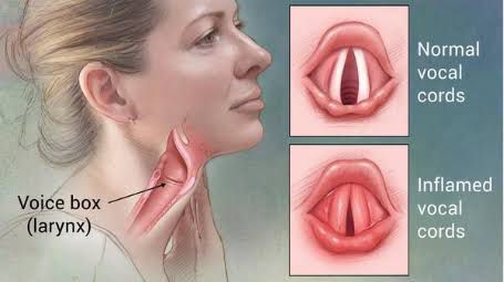 Diagnosing laryngitis - MEDizzy