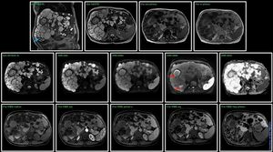 MRI Liver Imaging w/Primovist – Polycystic Liver @ Siemens - MEDizzy