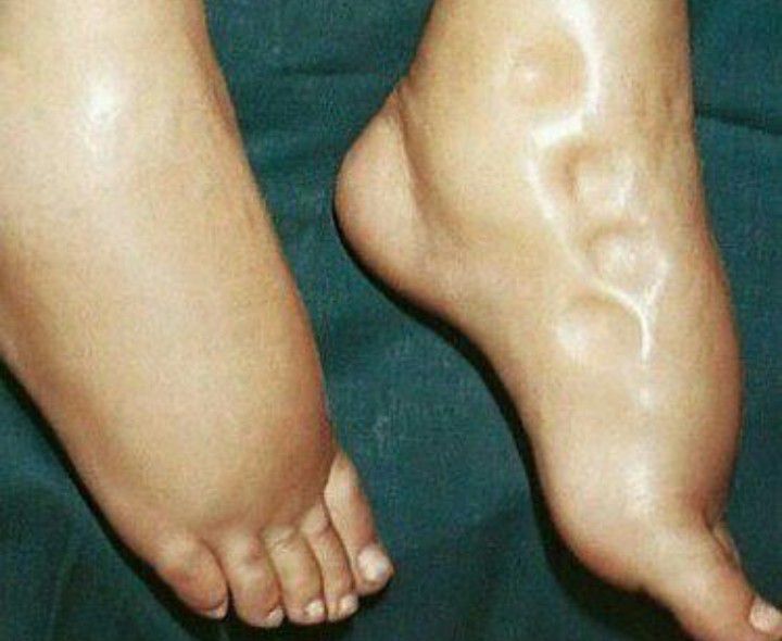 Pitting Edema MEDizzy