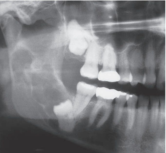 Calcifying Epithelial Odontogenic Tumor