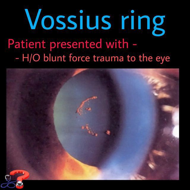 vossius ring uveitis