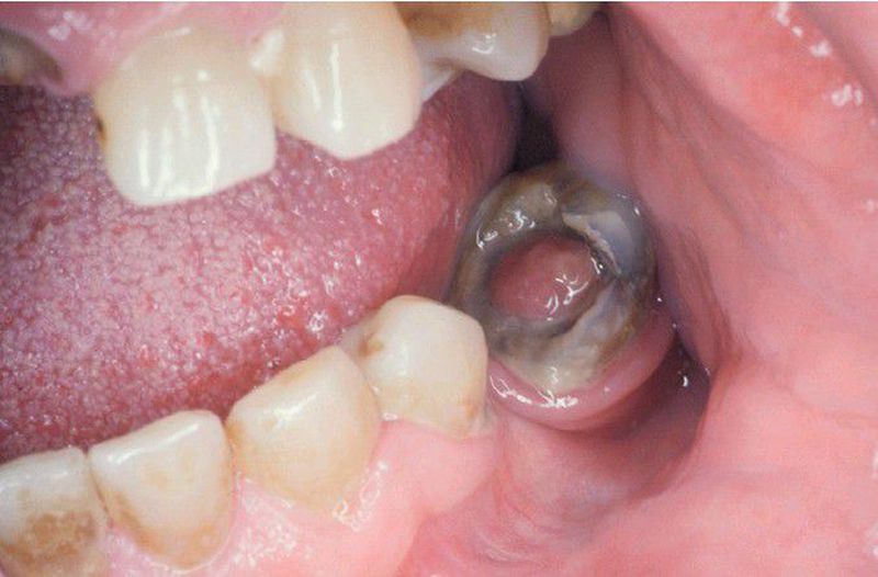 Chronic Hyperplastic Pulpitis JaypeeDigital | EBook Reader