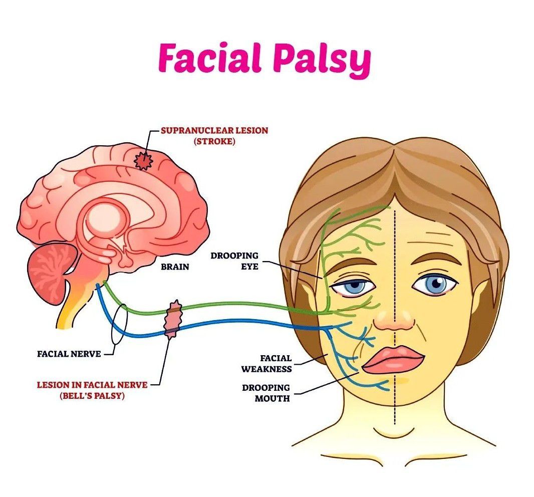 Facial Palsy - MEDizzy
