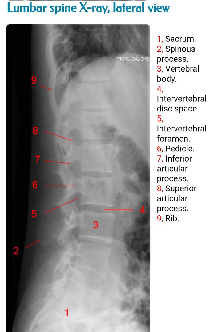 Lumbar x ray ... - MEDizzy